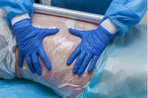 Appendectomy Surgery Shanti Madan Memorial Hospital