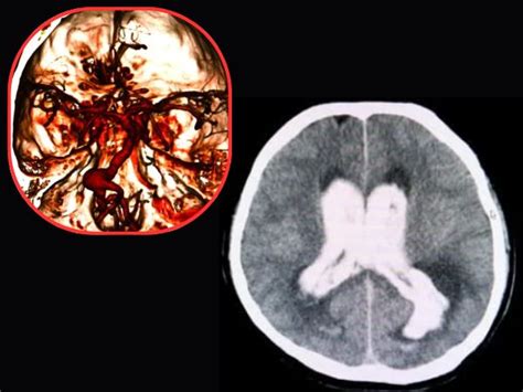 Clinical Presentations Intracranial Angiosarcoma Dr Deepak Agrawal