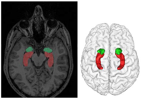 Amygdala Hippocampus Mri