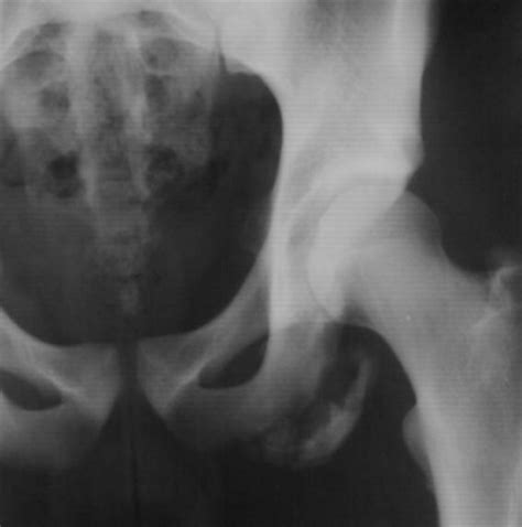 Pulled Hamstring Mri