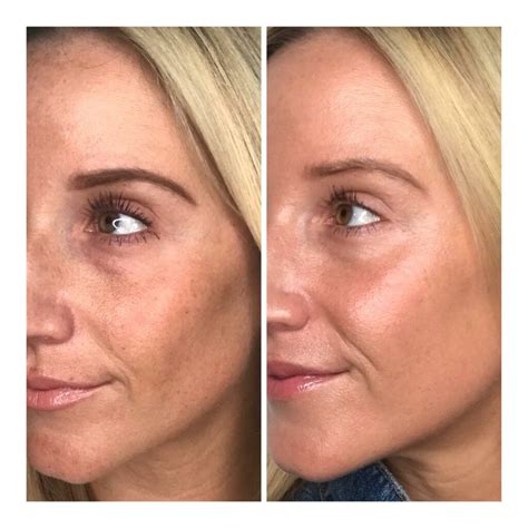 Post Laser Glow Essential Aftercare Tips For Smooth Skin Laser Hair
