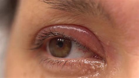 Inilah Jenis Jenis Blefaritis Yang Perlu Diwaspadai
