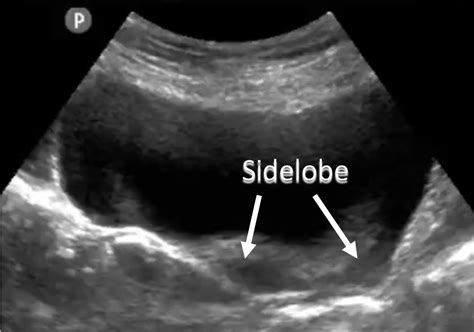 Artifacts In Ultrasound Sidelobe