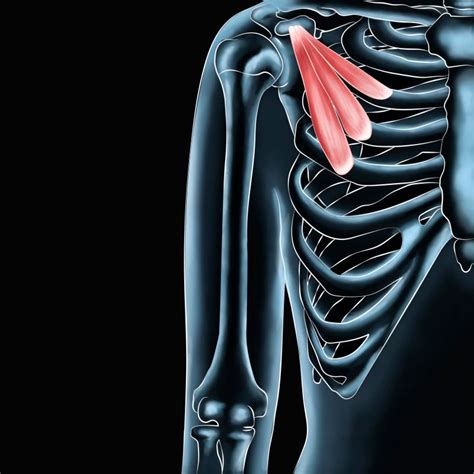 Athletes Choice Massage On Linkedin Preventing And Treating Pectoralis Minor Injuries Effectively