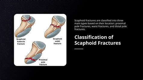 Scaphoid Fracture Overview Understanding And Treatment Ppt