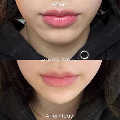 에이탑뷰티클리닉┃필러보톡스피부관리 Atop이 찾아드리는 세련된 V라인 ️ 뭉툭한 무턱의 턱라인을 매끄러운 V라인 턱으로 교정해드리는 에이탑 턱끝필러 📌전체적인