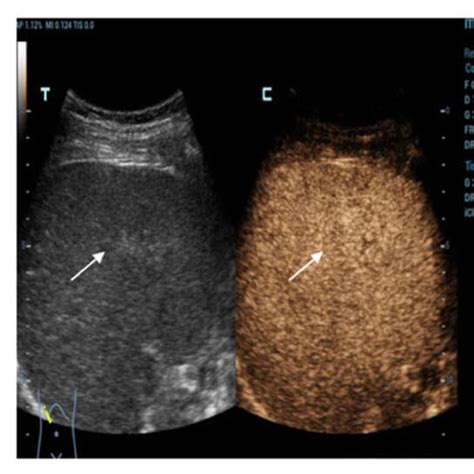 Contrast Enhanced Ultrasound Examination Of Liver Segment 6 Lesion A Download Scientific