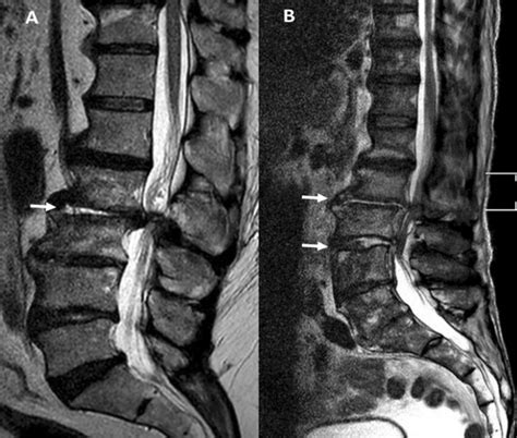 Mri Stir Sagittal Sequence Sl Psd A And Adjacent Ml Psd B Download Scientific Diagram