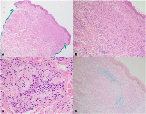 Diffuse Xanthomas In A Patient With Lipoprotein X Hyperlipidemia Pmc