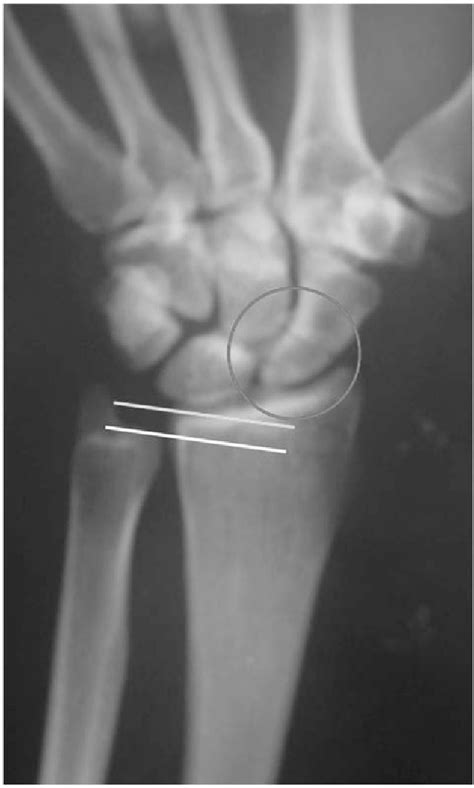 Figure 1 From Ulnar Variance And Scaphoid Fracture Semantic Scholar