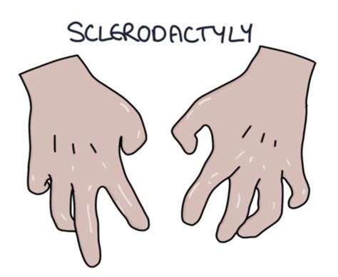 Systemic Sclerosis Flashcards Quizlet