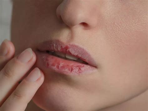 Vitamin B Deficiency Lips