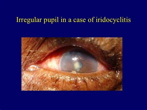 What Is A Festooned Pupil At Jose Norman Blog