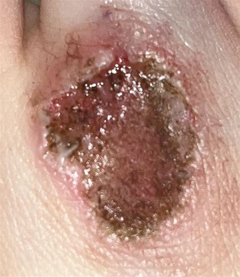 Is The Wart Still There It Looks Like Its Spreading I Did Electric