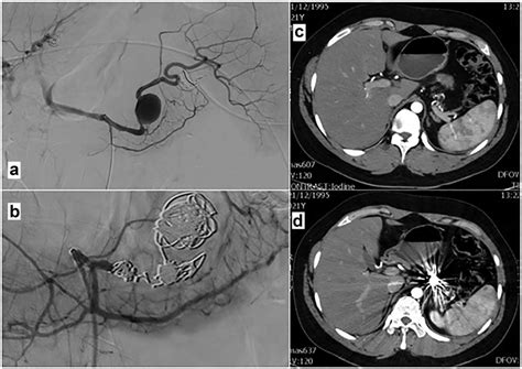 Splenic Artery Aneurysm