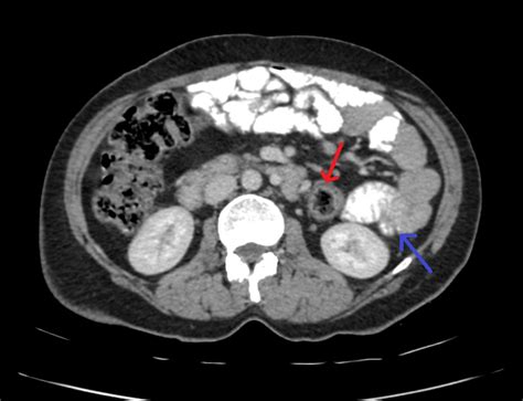 Persistent Descending Mesocolon An Under Recognized Entity Eurorad