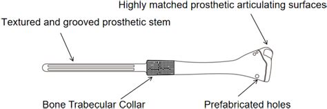 3d Printed Metal Prostheses Offer New Hope For Distal Radius Giant Cell Tumor Patients 3d