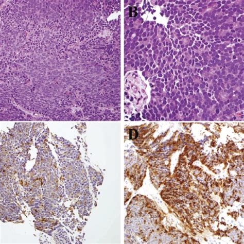 Cystoscopic Exam Revealed Multiple Exophytic Masses Arising From The Download Scientific