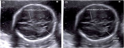 Transventricular Plane A Original And B Transmitted Images Download Scientific Diagram