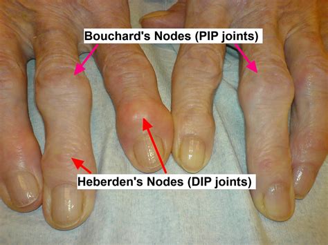 Arthritis Feet Nodules At Bonita Walker Blog