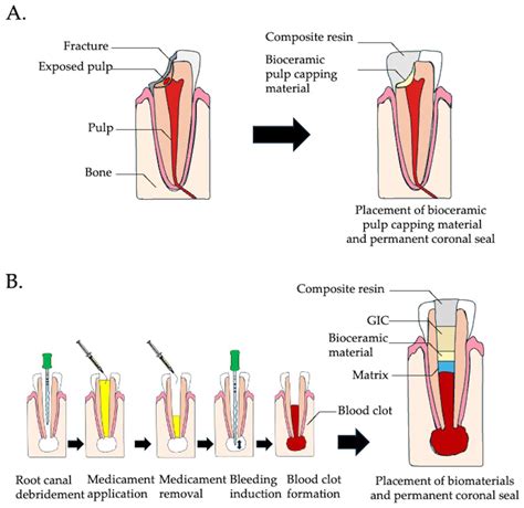 Endodontic Regeneration Therapy Current Strategies And Tissue