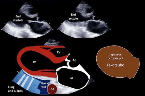 Takotsubo Cardiomyopathy • Litfl • Ecg Library Diagnosis