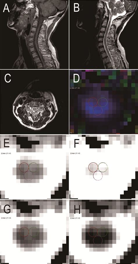 Diffusion Tensor Magnetic Resonance Imaging In Chronic Spinal Cord
