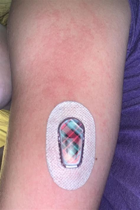Rash R Dexcom