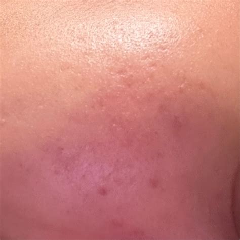 저 곰보 피부인가요 여드름 흉터 많이 심한가요 지식in