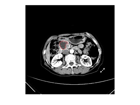 Matlab Programming Tumor Classification System Of Ct