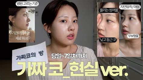 가짜 코 달기가 이렇게 힘든거였다니🥵쌍수무보형물 수술 후기👃 부기관리법성형정보초현실주의 성형vlog 성형후기 쌍수 성형브이로그 Youtube