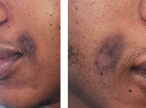 Hyperpigmentation Face