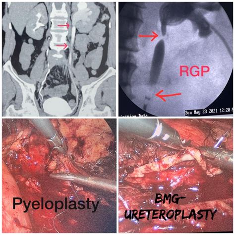 Simultaneous Laparoscopic Left Pyeloplasty Bmg Ureteroplasty For Puj