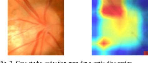 Figure 1 From Glaucoma Grading Using Multimodal Imaging And Multilevel
