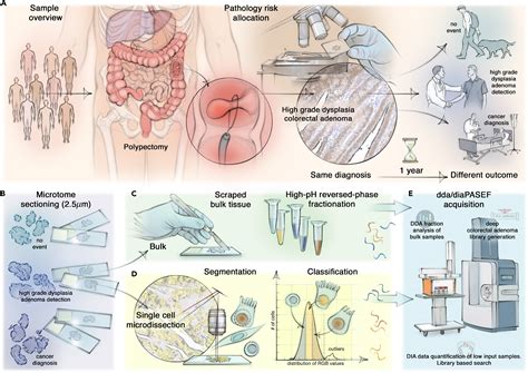 Spatial Characterization And Stratification Of Colorectal Adenomas By