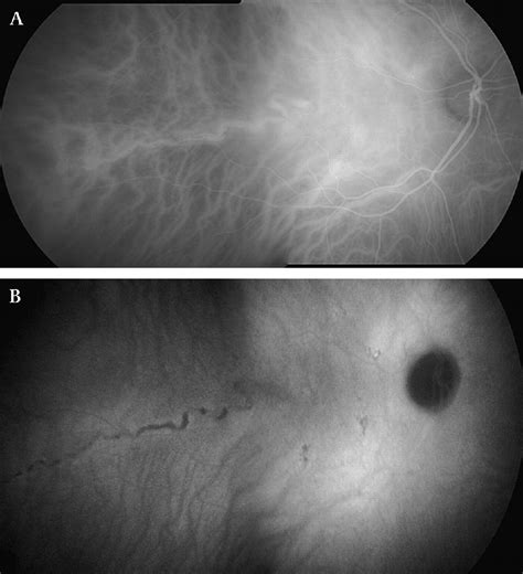 Choroidal Macrovessel British Journal Of Ophthalmology