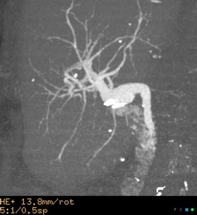 Cholangiogram Procedure