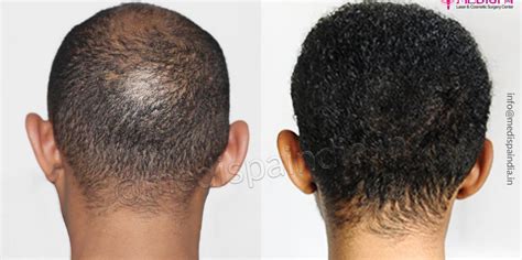 Can Hair Transplant Help Curing Alopecia