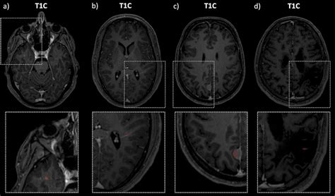 Can Ai Bolster Mri Lesion Detection And Segmentation In Patients With Multiple Sclerosis