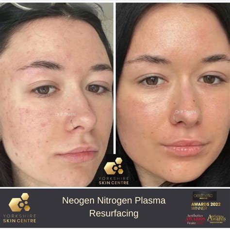 Dark Spots On Face