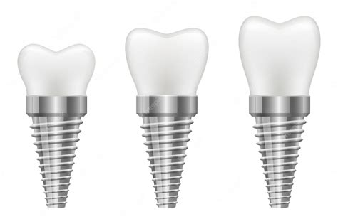 치아 임플란트 그림 흰색 배경에 고립 프리미엄 벡터