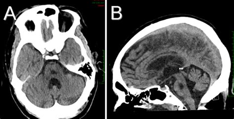 Osmotic Demyelination Syndrome