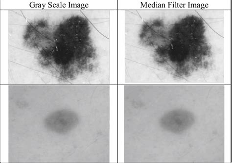 Preprocessing The Dermoscopic Images Download Scientific Diagram