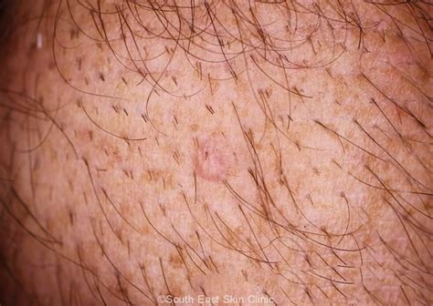 Bcc Basal Cell Carcinoma
