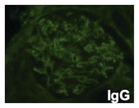 Renal Biopsy Showing Deposition Of Immunoglobulin G Igg And Download Scientific Diagram