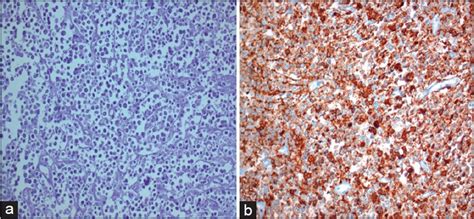Everolimus For The Treatment Of Cd20 Diffuse Large B Cell Lymphoma In
