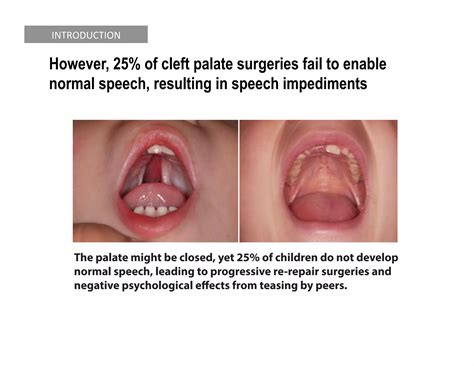 Helping Plastic Surgeons Improve Cleft Palate Surgery Ppt