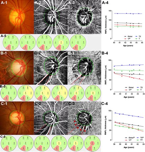 Representative Eyes With Primary Open Angle Glaucoma A Without A