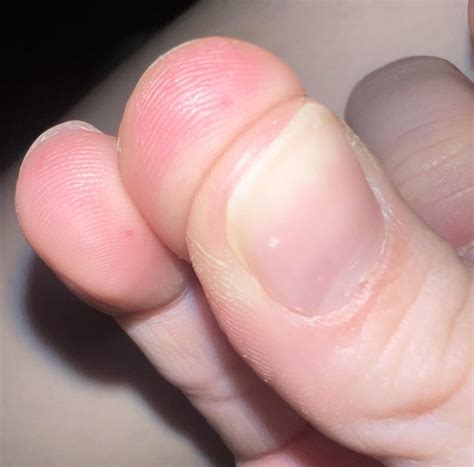 What Are These Dots On My Fingers Rdermatologyquestions