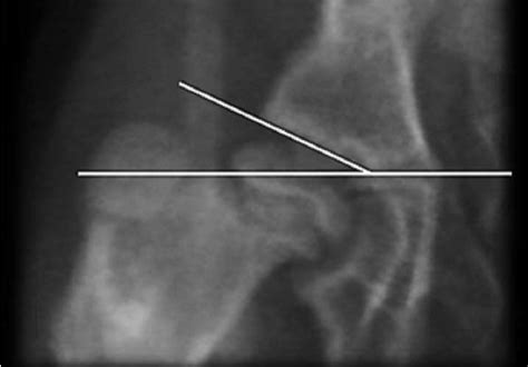 Acetabular Index Ai Formed By A Horizontal Line Connecting Both Download Scientific Diagram